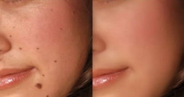 Petualang si Bolang: Tips Menghilangkan Kutil secara Natural