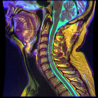 Nevit's blog: Color MRI of the Cervical Spine