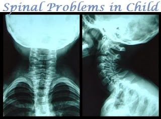 Chiropractic & Laser Therapy: Spinal Problems in Child: A Threat During ...