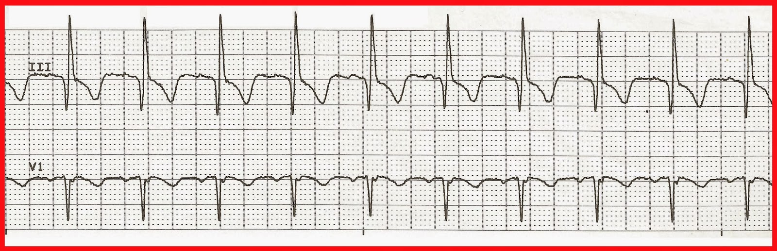 Practice EKG Rhythm Strips 222