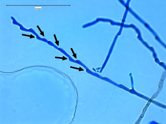 Fun With Microbiology (What's Buggin' You?): Fonsecaea pedrosoi/monophora