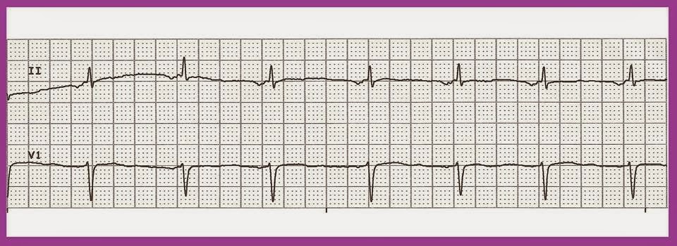 Various Accelerated Junctional Rhythms