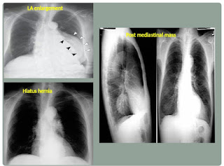 Chest Medicine Made Easy-Dr Deepu: Important chest radiology signs.