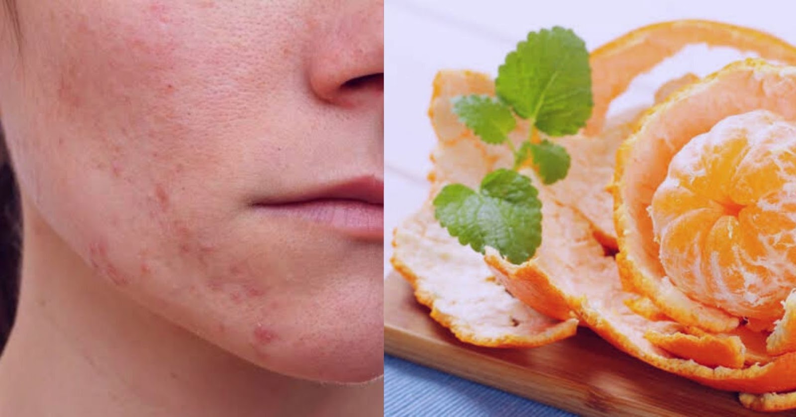 Relieve Your Skin Diseases With Orange Peel
