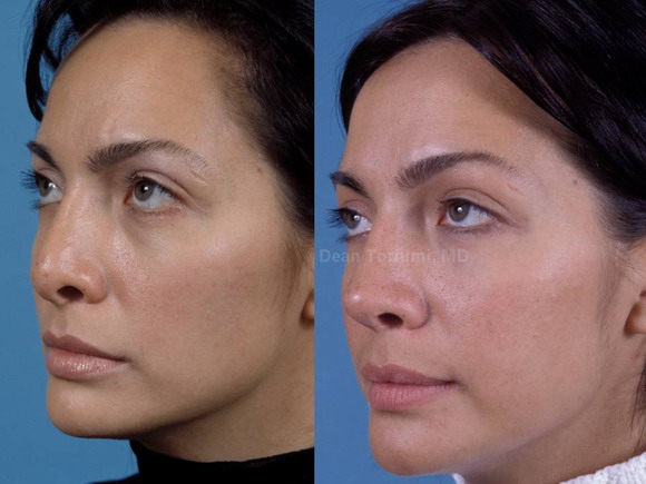 Dr. Dean Toriumi Reviews: Secondary Rhinoplasty surgeries: 2