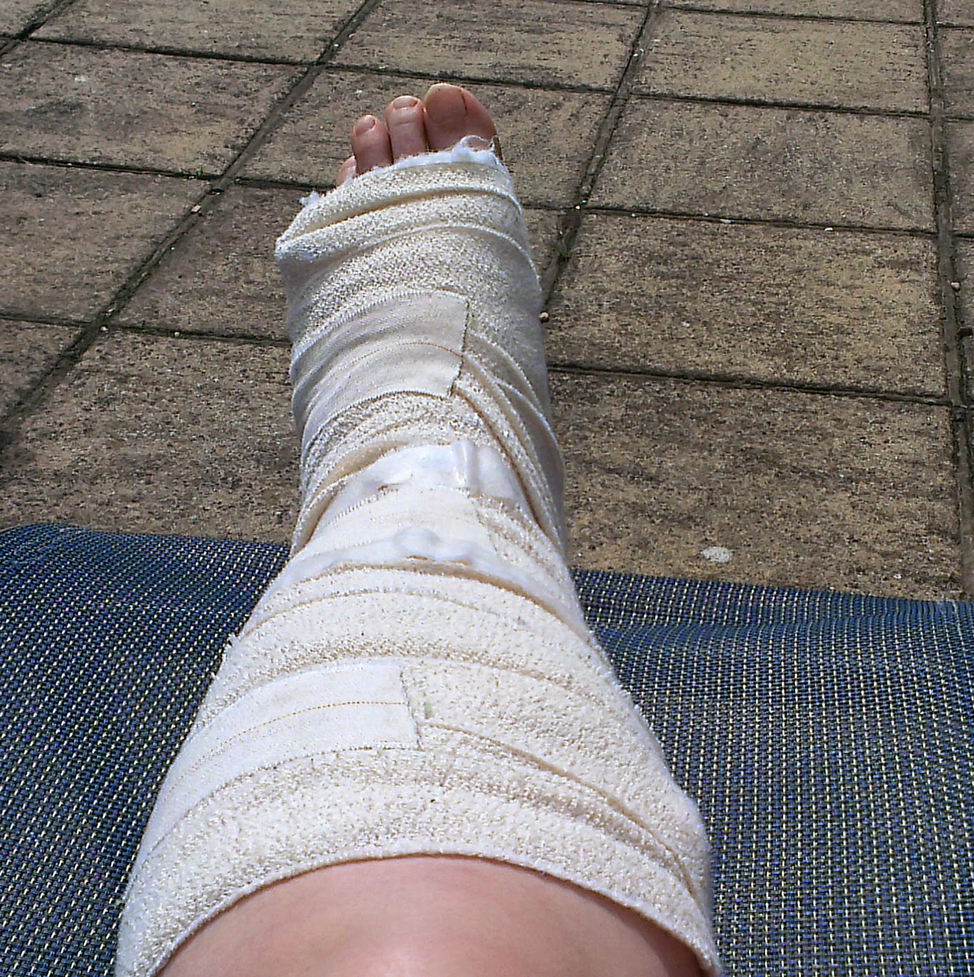 List 91+ Pictures How To Walk With A Cast On Foot Completed