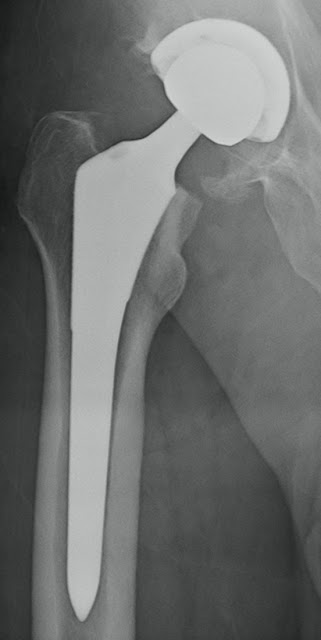 Photons and Electrons: My Minimally Invasive Total Hip Replacement With ...