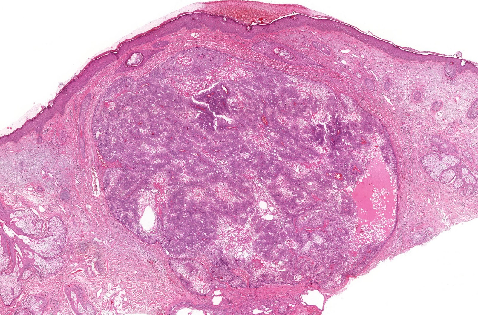 Differential Diagnosis in Dermatopathology: Clear cells