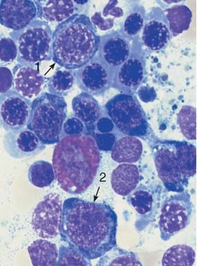 [Haematology] Abnormalities of the White Cell Series | Free Medical Atlas