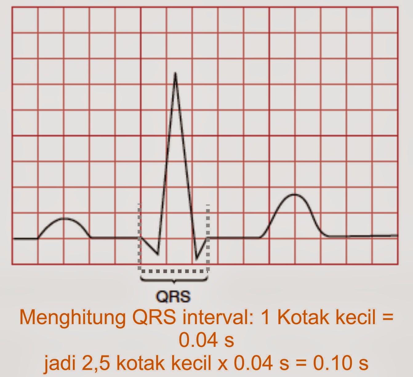 Interpretasi EKG 5 Langkah