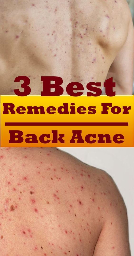 3 Best Remedies For Back Acne - Sweet Oh Joy