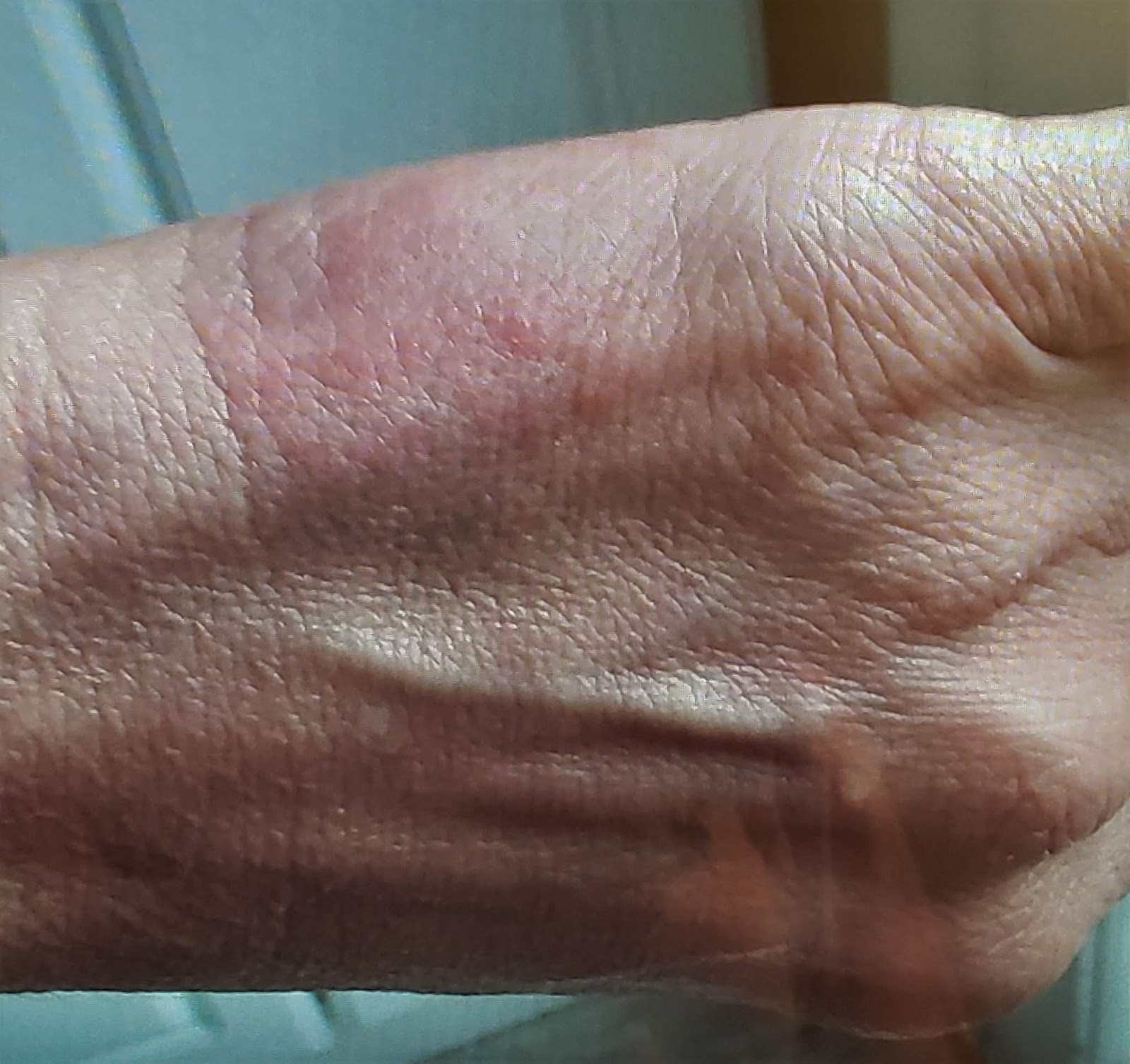 Wasp Sting: Reaction, Treatment, Remedy and Black Dot from a Wasp Sting