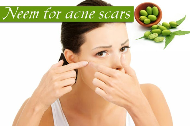 Home remedies with Neem leaf for acne scars - healthy and beauty tips