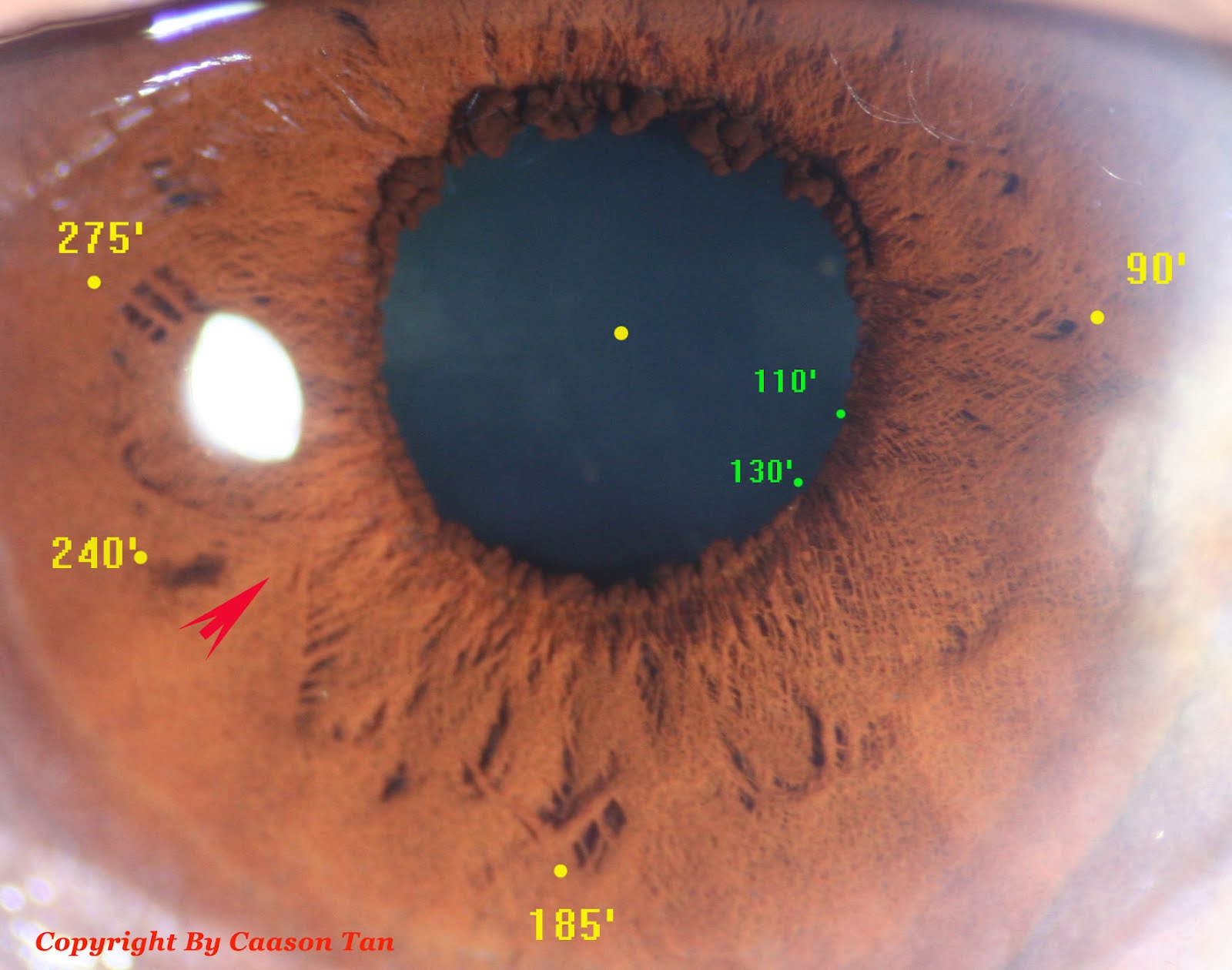 Modern & Multidimensional Iridology: Deviations In The Frontal ...