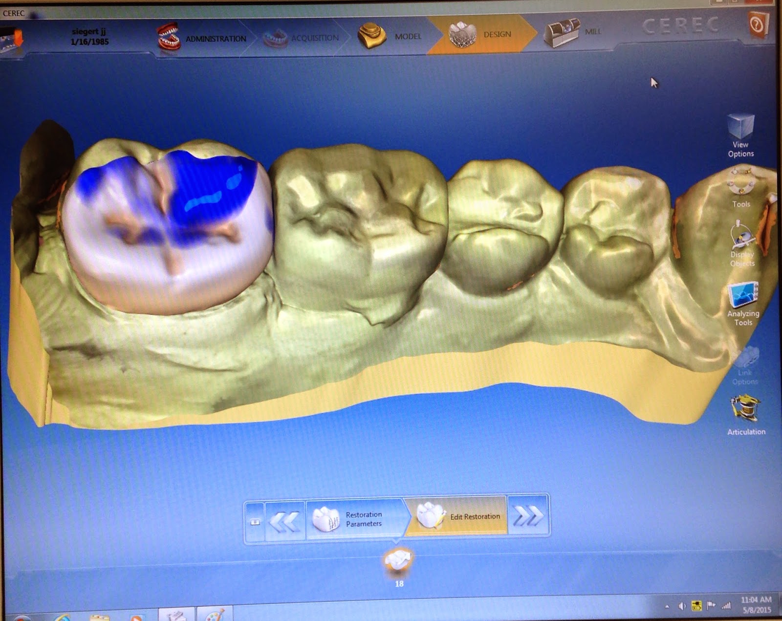 The Tooth, The Whole Tooth, & Nothing but The Tooth: CEREC single visit ...