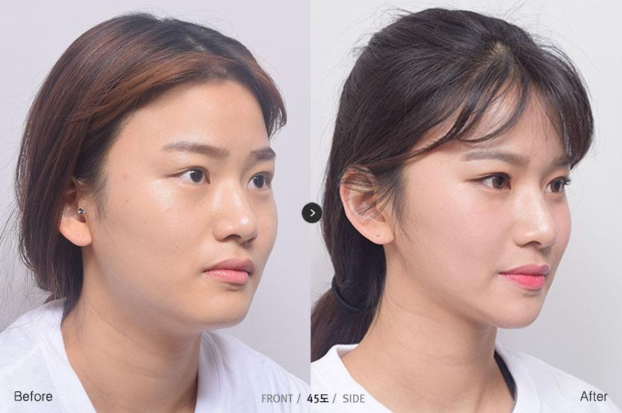 What is genioplasty? Do I need genioplasty?