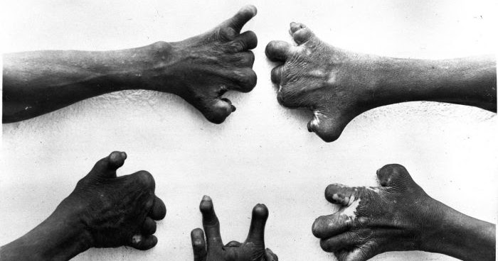 Kusta atau Lepra: Definisi, Penyebab, Gambaran Klinis dan Pencegahan ...