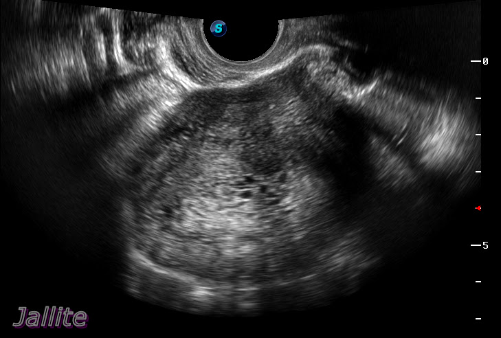 Mola Hidatiforme Incipiente