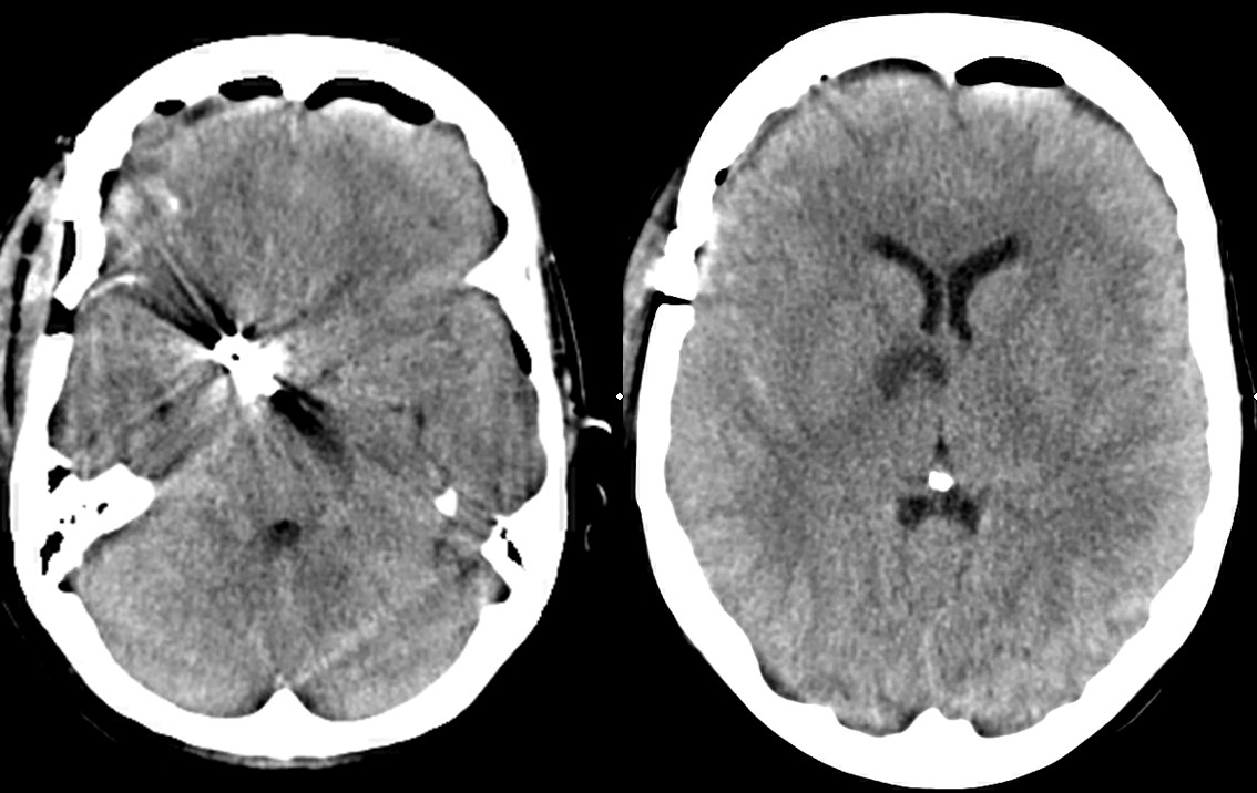 Dr Balaji Anvekar FRCR: PCOM aneurysm clipping with anterior choroidal ...