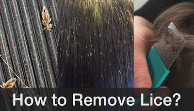 How To Get Rid Of Lice Fast - Caraway Seeds Health Benefits
