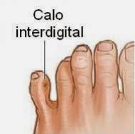 Calos & Calosidades - um problema dolorido mas de fácil tratamento.
