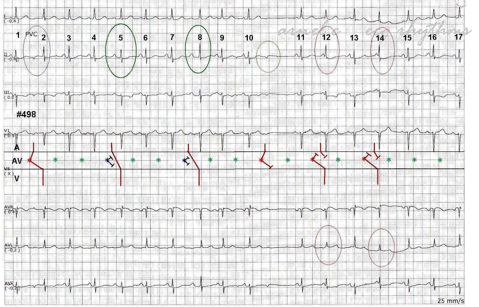 ECG Rhythms: Several tricks of a PJC in one strip