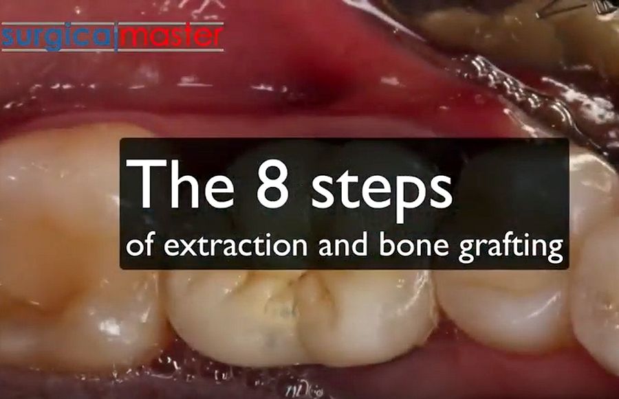 The 8 steps of EXTRACTION and BONE GRAFTING - Surgical Master The 8 steps of EXTRACTION and BONE GRAFTING - Surgical Master