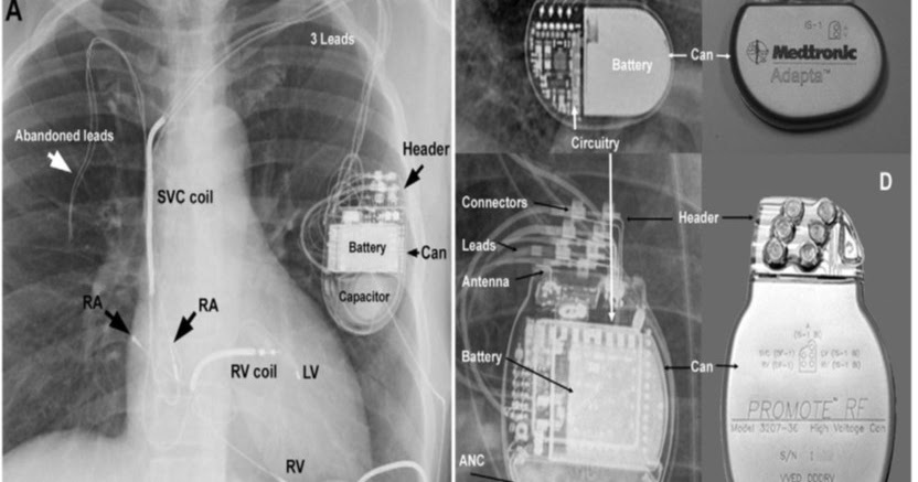 Pedi cardiology: How to identify pacemaker?