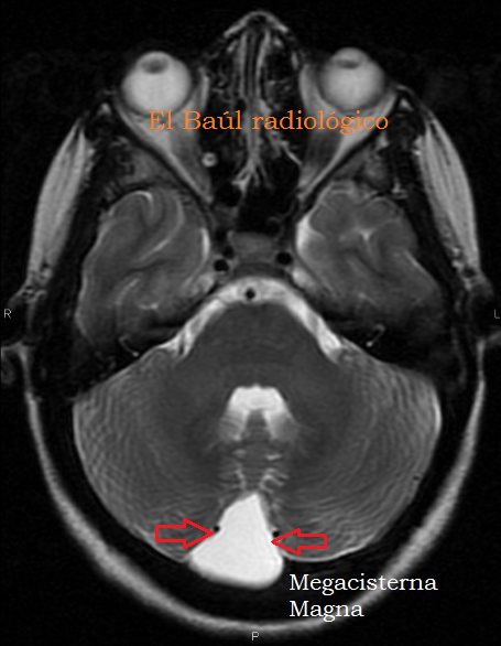 El Baúl Radiológico: ASPECTO DE LA CISTERNA MAGNA EN TOMOGRAFÍA ...