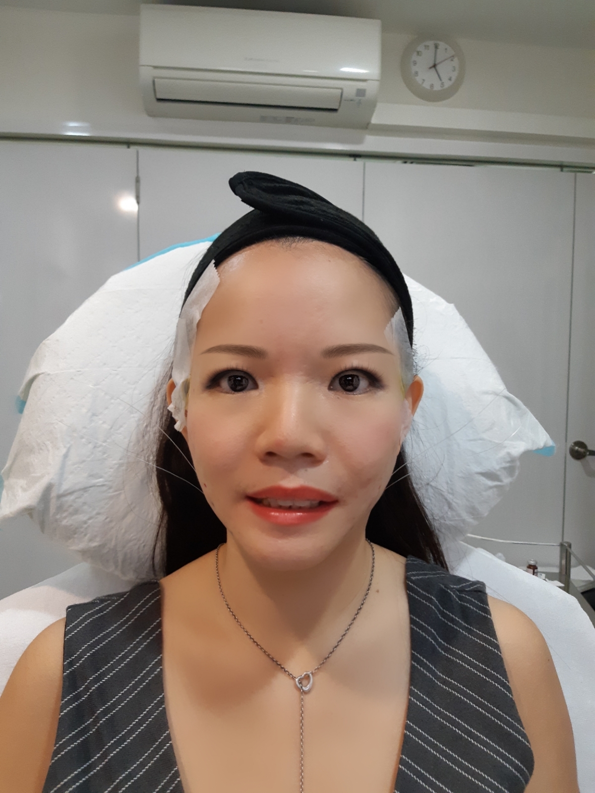 TheArcticStar's Tales: Review on Happy Lift Threadlift Procedure @ EHA ...