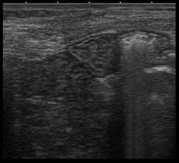 O Radiologista: Aderência Intestinal - Ultrassonografia