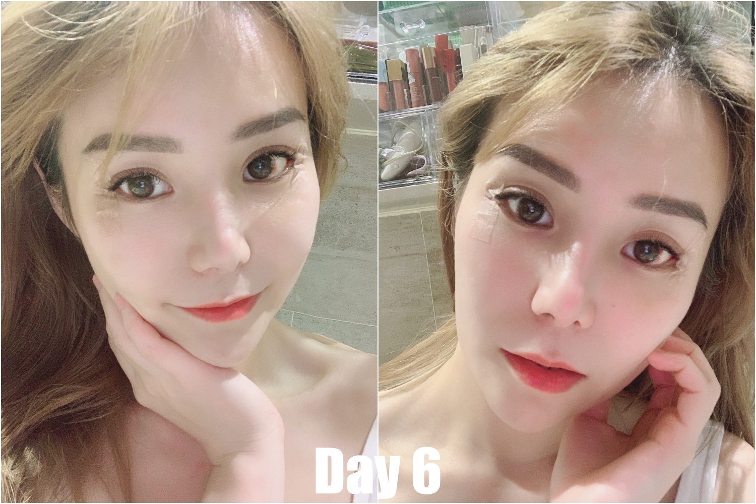 My Epicanthoplasty Journey with The Clifford Surgery Clinic - aggylow