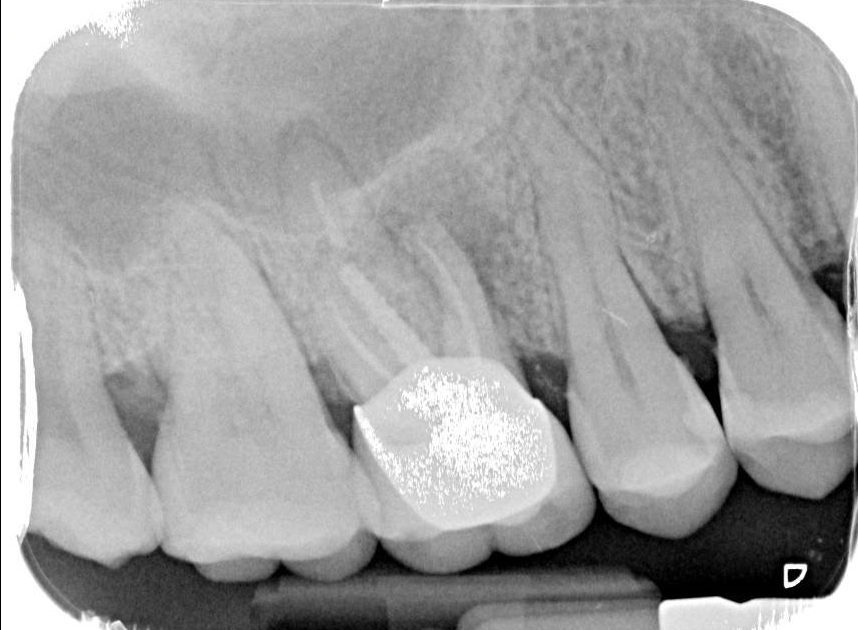 Caso clínico Máster: Retratamiento 16