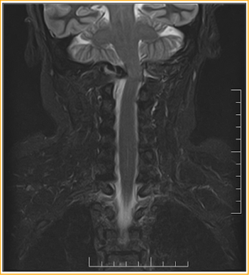 Basilar Invagination-MRI - Sumer's Radiology Blog