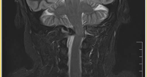 Basilar Invagination-MRI - Sumer's Radiology Blog