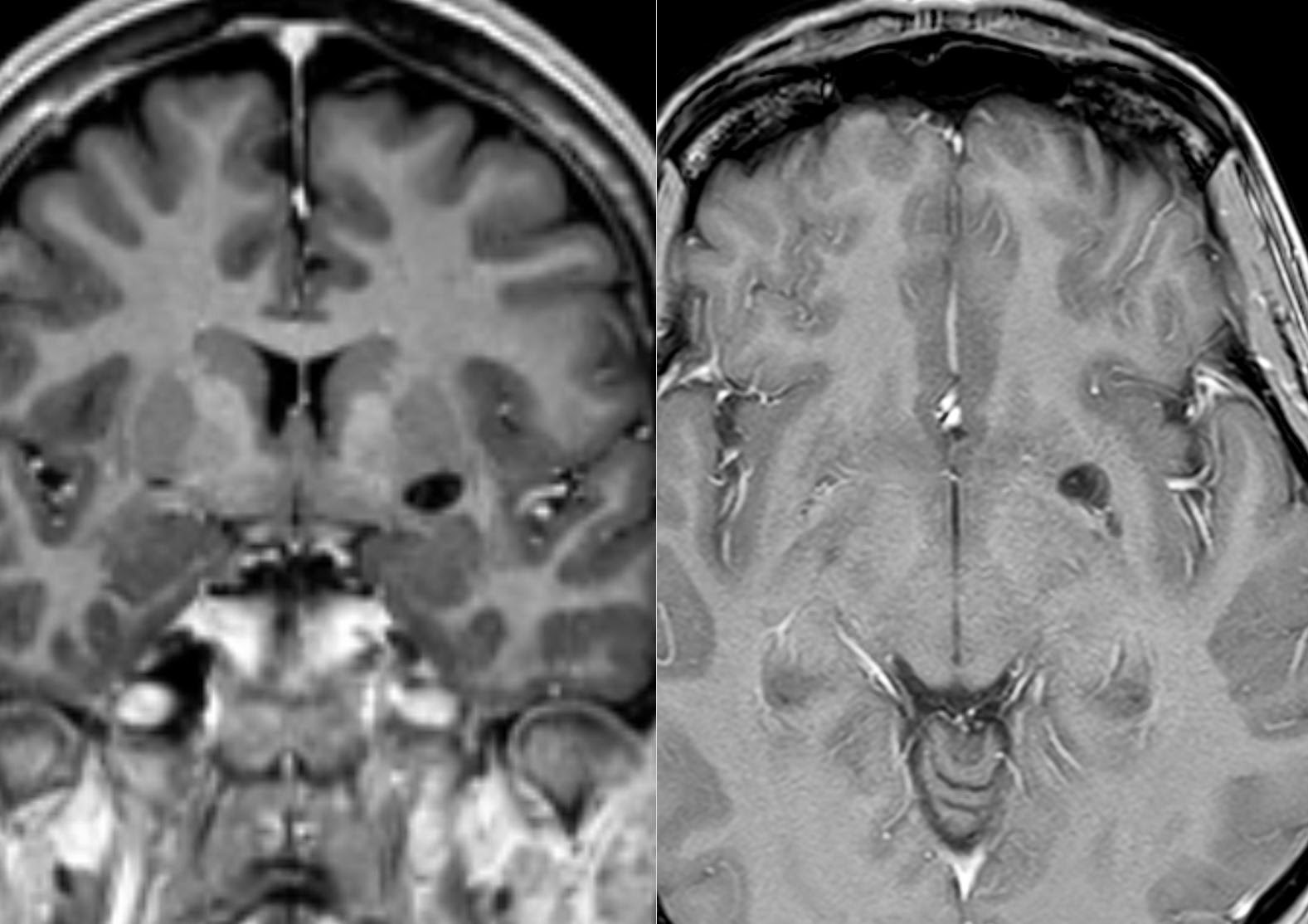 Smiling Perivascular Space