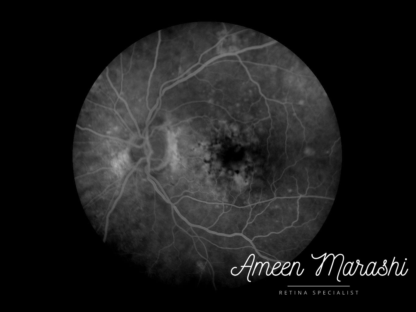 Fluorescein angiography features for drusen