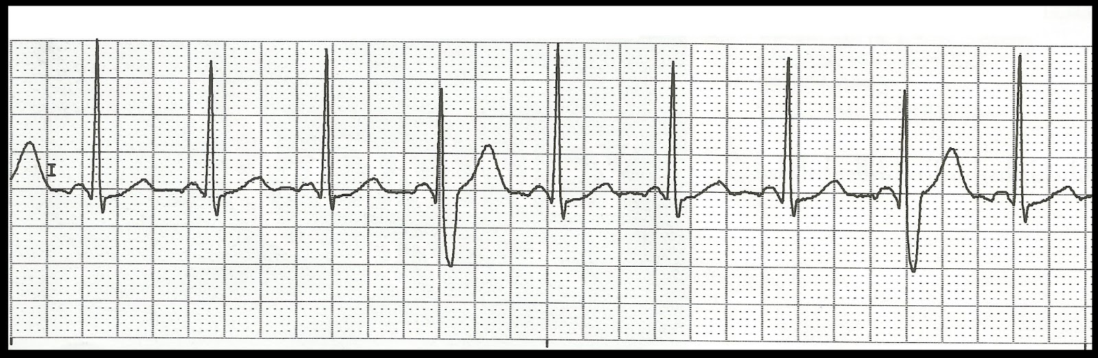 Practice EKG Rhythm Strips 168