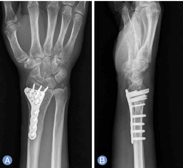 Left Distal Radius Fracture Icd 10 Alles Was Sie über Formulare In Deutschland Wissen Müssen