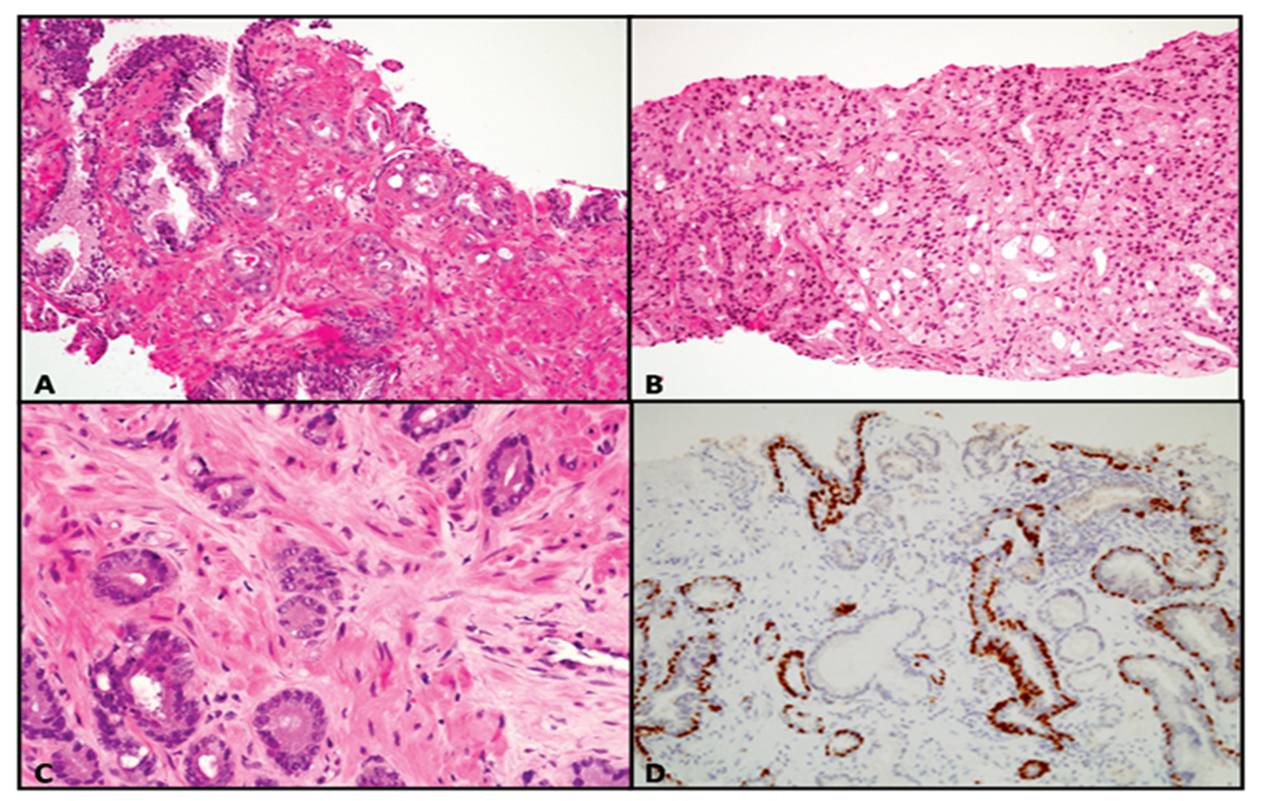 GO BIG or GO HOME: Pathology of prostate gland adenocarcinoma and its ...