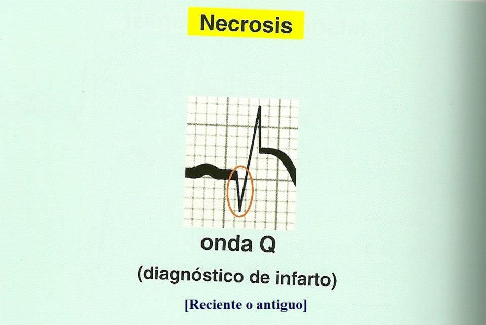 Dr. Rafael Soto - Electrocardiografía - Cardiología clínica: Infarto ...