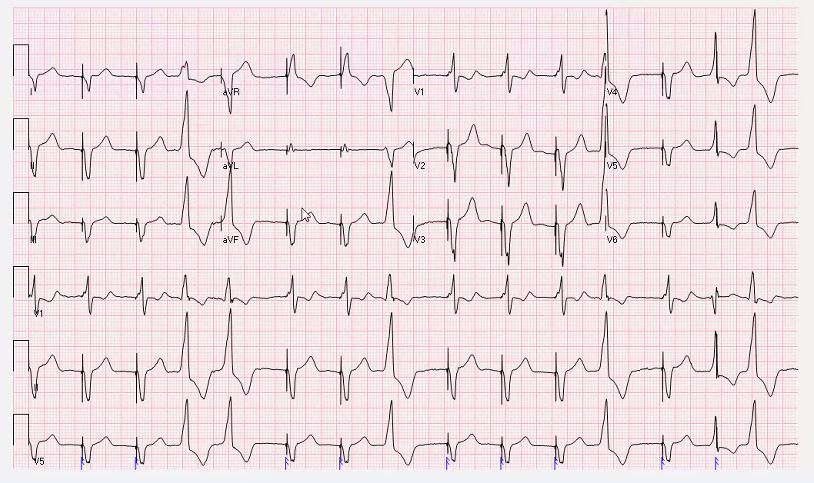 Medicowesome: Determining pacemaker type from EKG (RV pacing vs ...