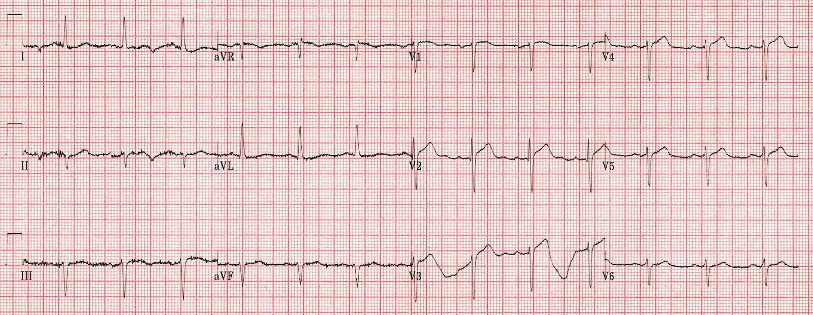 ACLS REVISION