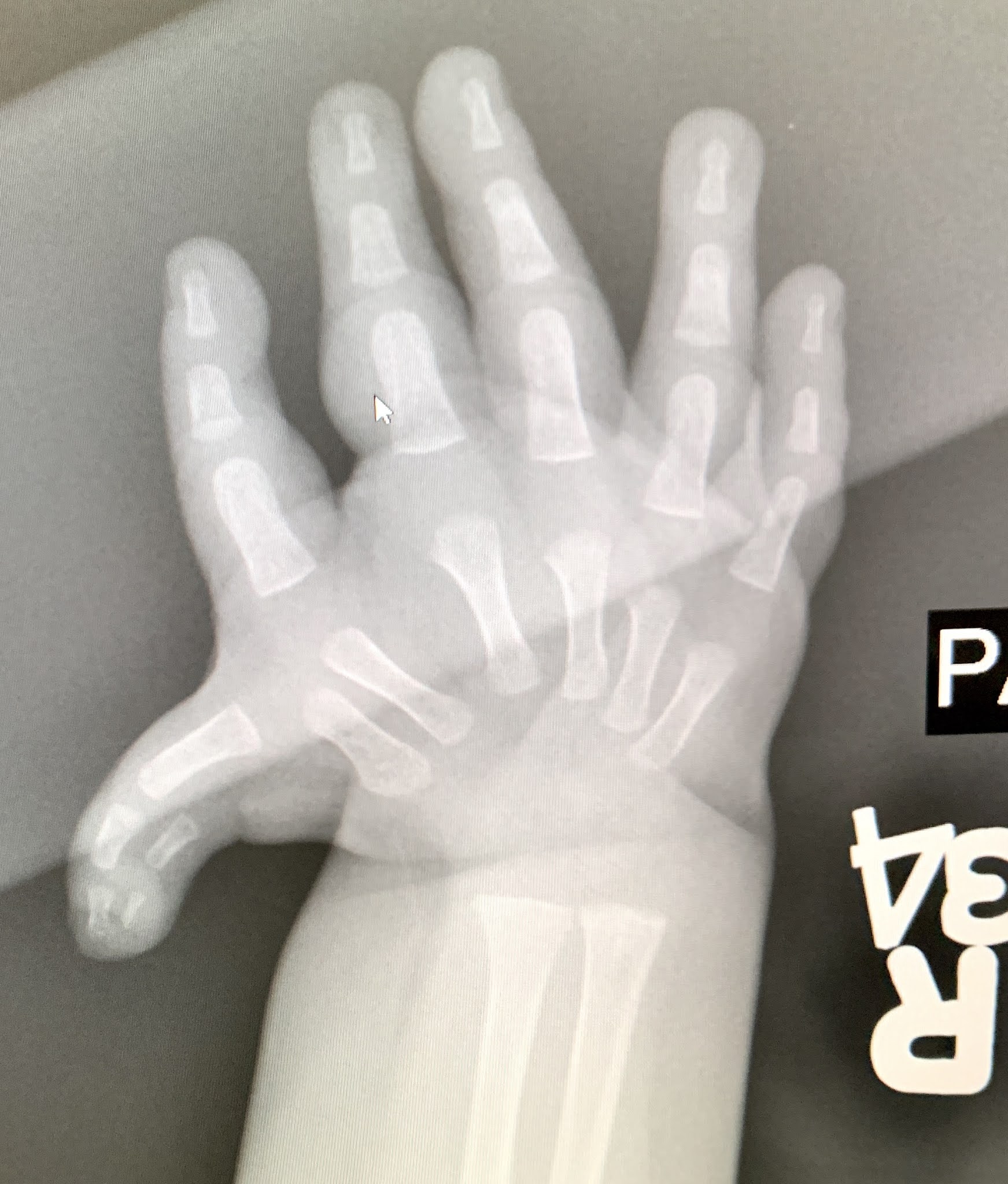 Congenital Hand and Arm Differences