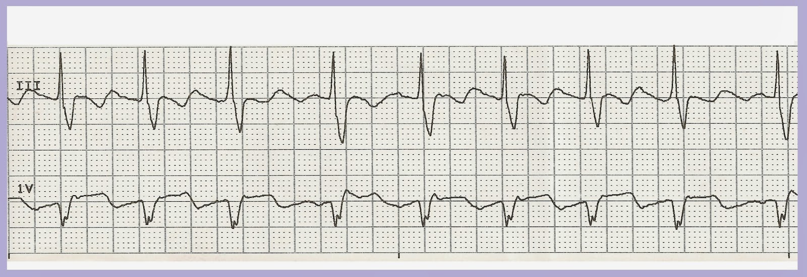 Practice EKG Rhythm Strips 217