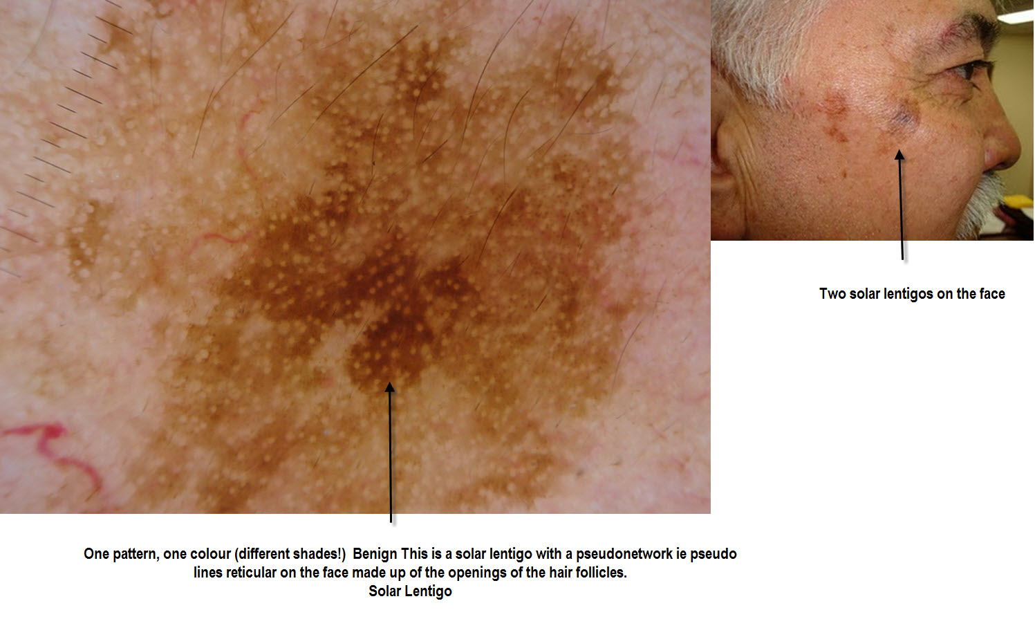 Dermoscopy Features as Clues: Lines Reticular