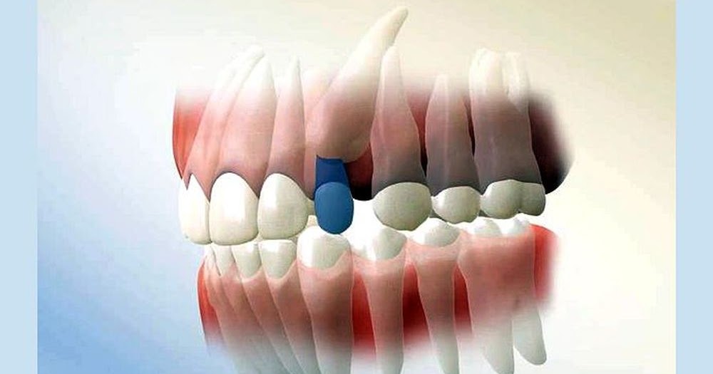 ORTHODONTIC : Serial Extractions in orthodontic – A Review - odontobebe