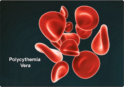 Medical Treatment Pictures-for Better Understanding: Polycythemia Vera