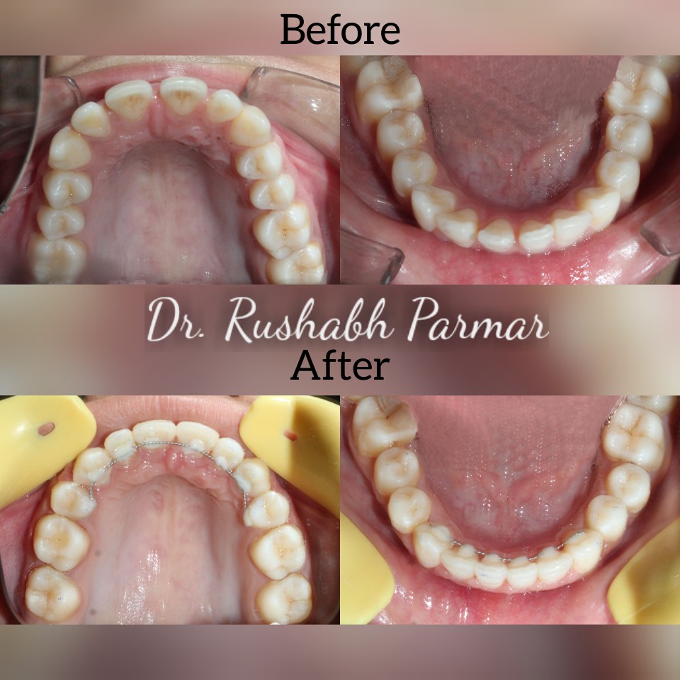 Management of Class II Division I malocclusion by Camouflage ...