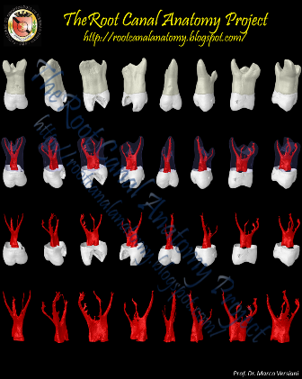 The Root Canal Anatomy Project: Taurodontism: Maxillary Second Molar